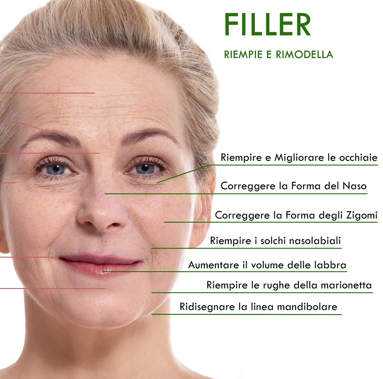 Fillers | C’est Quoi | Types de Fillers et Résultats