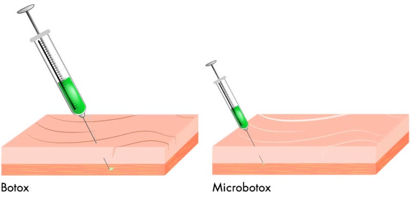 Microbotox o Mesobotox | Cos'è? Benefici, Risultati, Prezzo