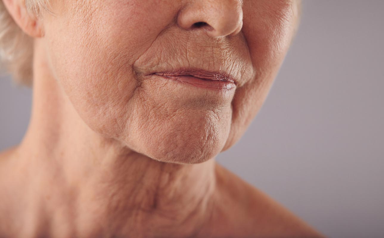 Elastose | Arten und Behandlung der Solaren Elastose