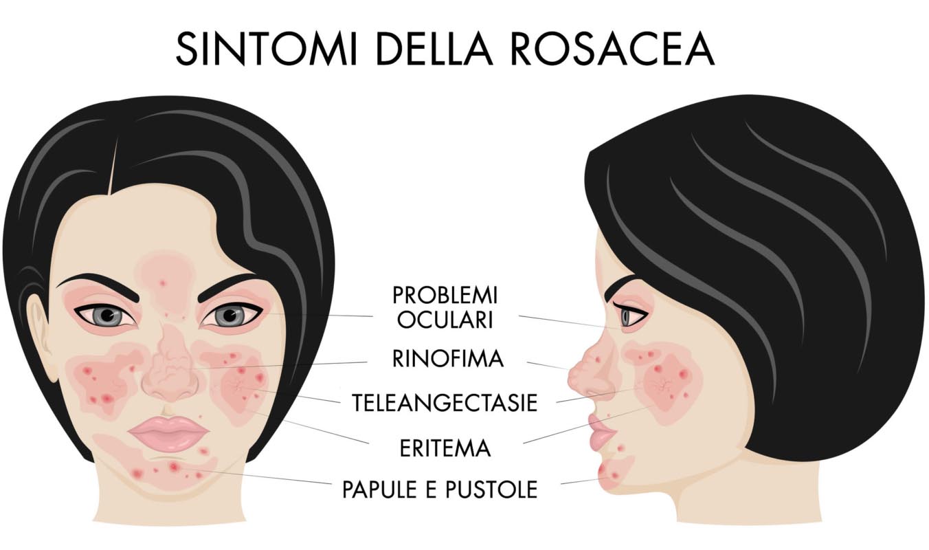 Rosacea | Cause, Sintomi, Tipi | Trattamenti e Consigli | X115®