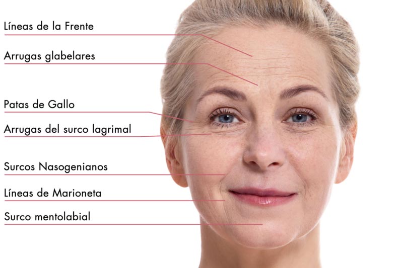 Arrugas Glabelares | Causas | Botulinum, Relleno, Tratamientos Eficaces ...