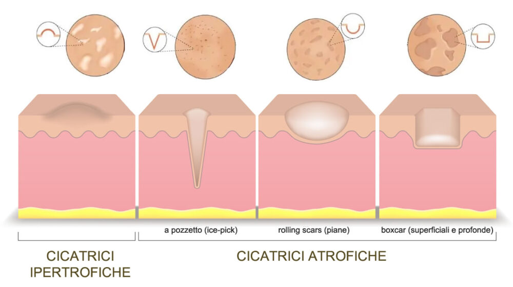 Cicatrici da Acne | Cause, Tipi | Trattamenti Efficaci per Eliminarle